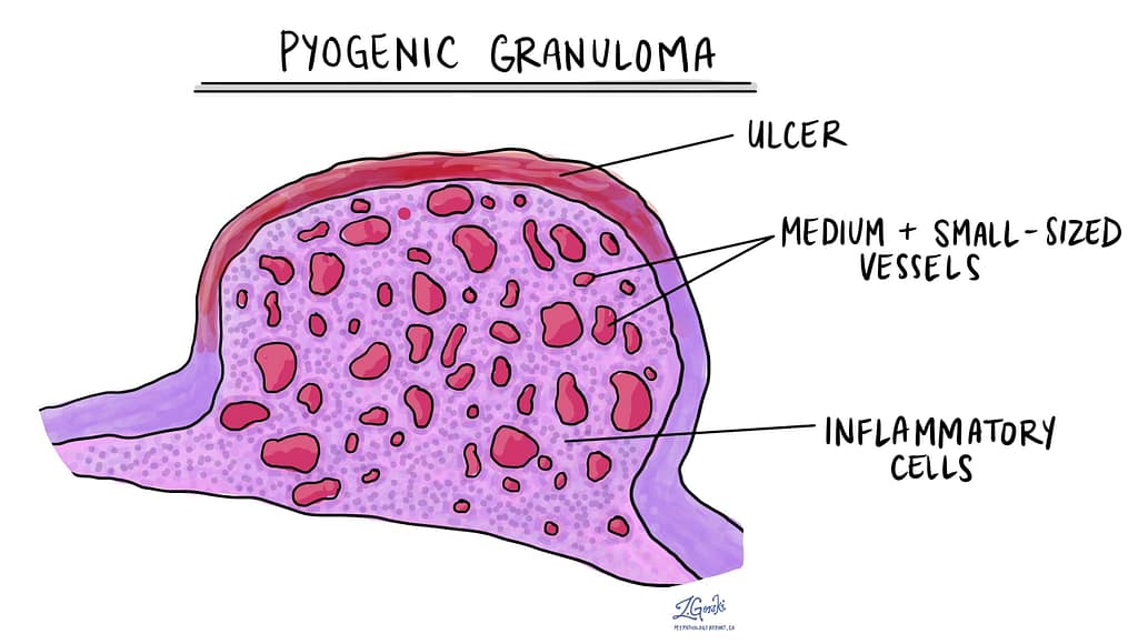 Treatment and Causes of Pyogenic Granuloma | PT. Ben Sehat Sejahtera